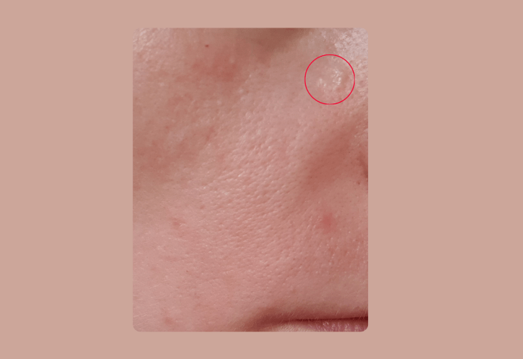 Bumps on the Skin? What If It’s Sebaceous Hyperplasia: Causes, Symptoms ...