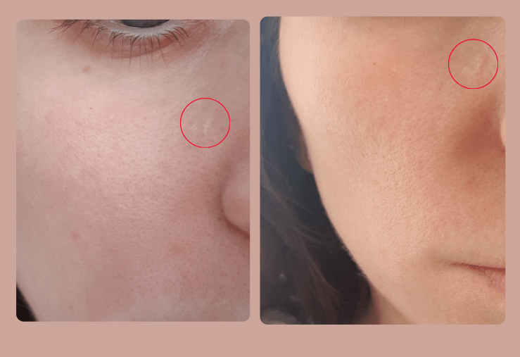 Bumps on the Skin? What If It’s Sebaceous Hyperplasia: Causes, Symptoms ...